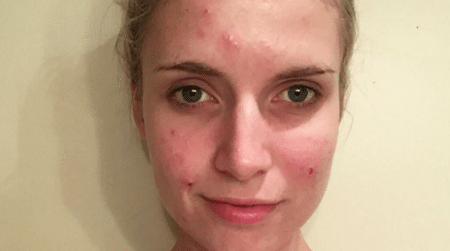 Pokazała zdjęcie bez makijażu i z trądzikiem. Ma ważny powód!